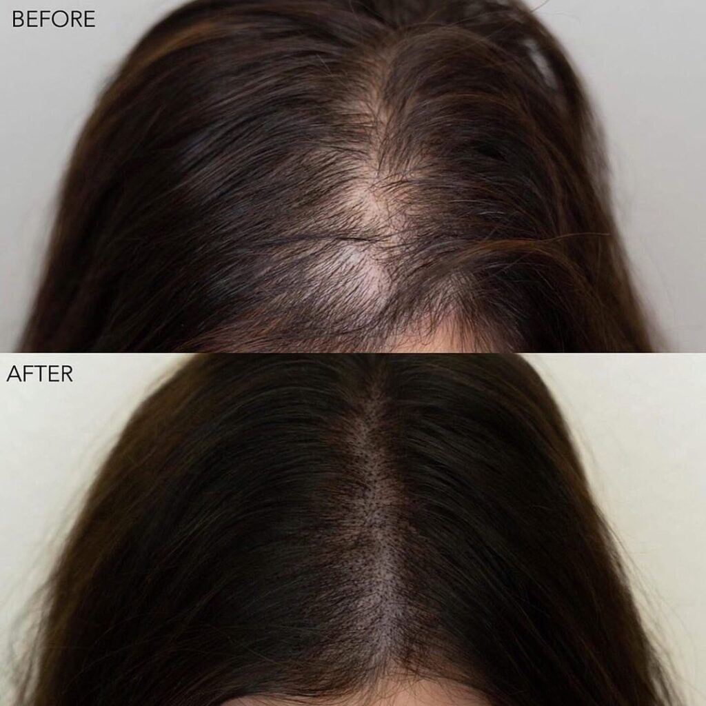 Getting scalp micropigmentation for female frontal hair loss - Sian Dellar